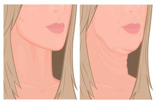 Dermatologists Explain How to Prevent Sagging Jowls – WHF.